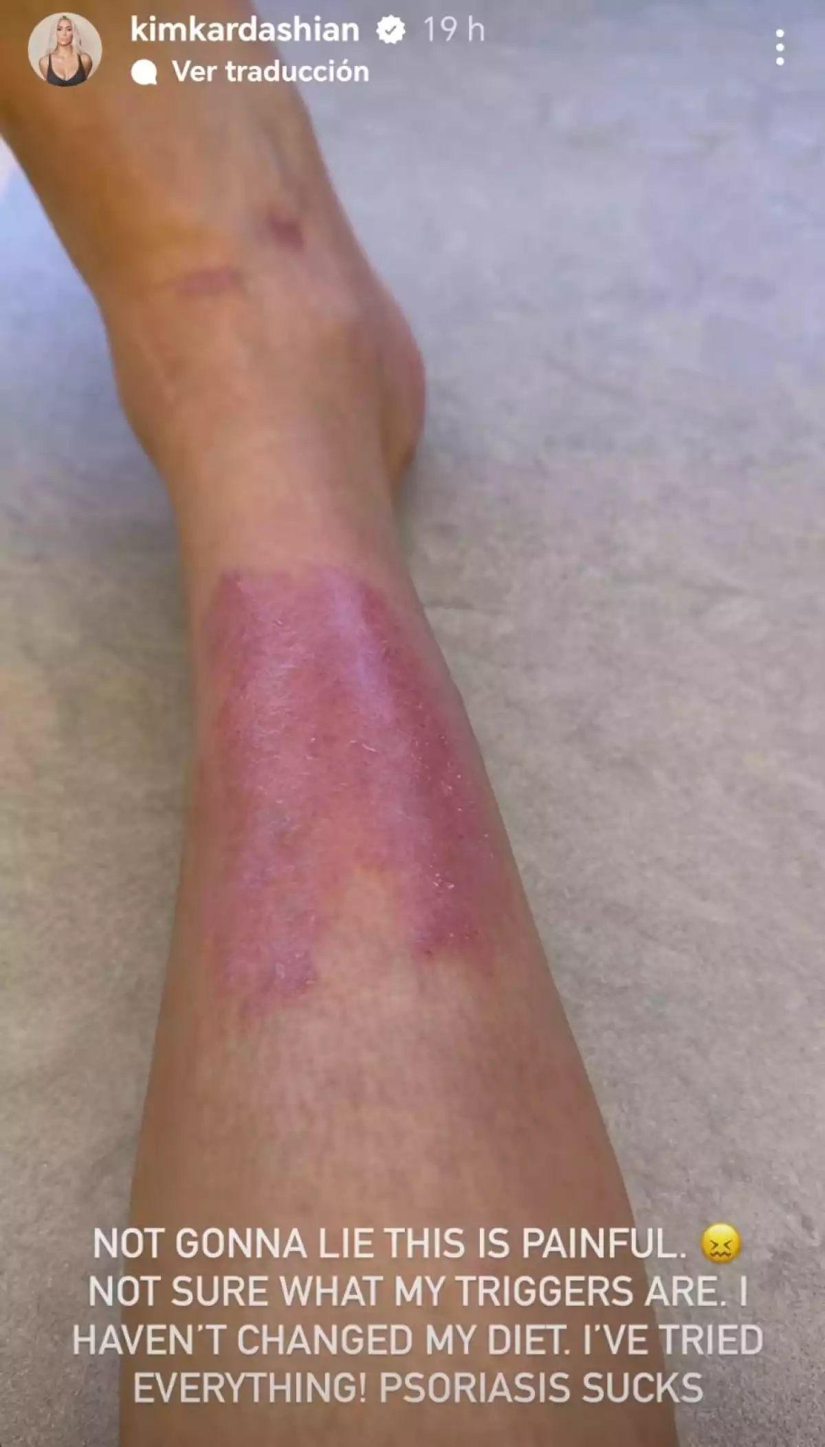 Kim Kardashian muestra el terrible daño que la psoriasis ha hecho en su ...