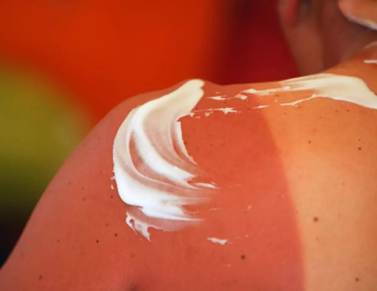 Cura las quemaduras del sol