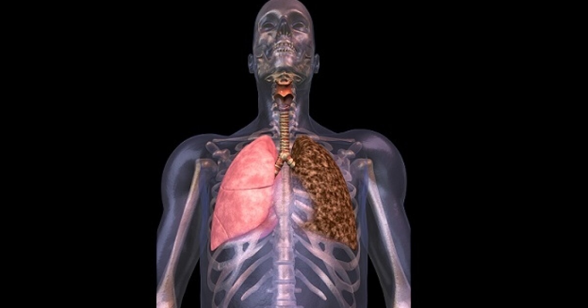 Qué es, cómo se produce y cómo se trata el enfisema pulmonar