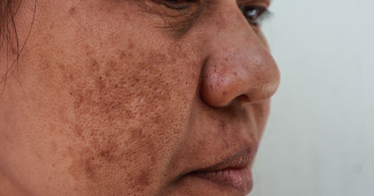 Hiperpigmentación de la piel: qué es, causas, tipos y posibles tratamientos