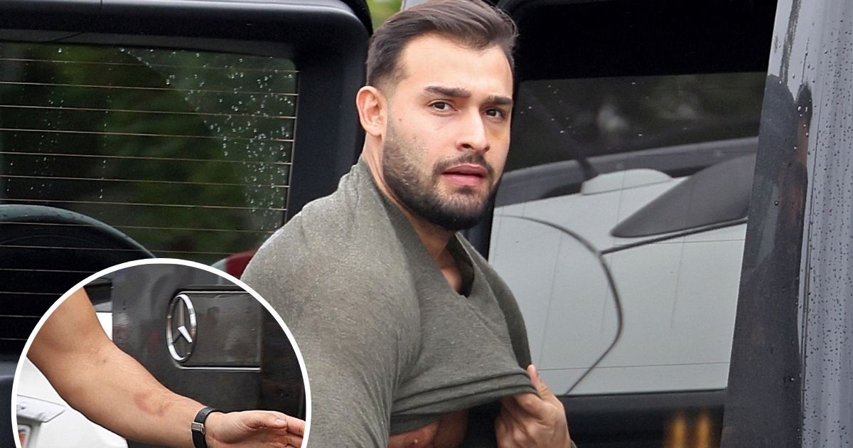 Resurgen fotos de Sam Asghari golpeado tras acusar a Britney de agresión