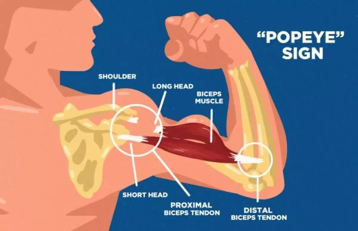Él tiene un brazo de 'Popeye'... y no es por comer espinaca