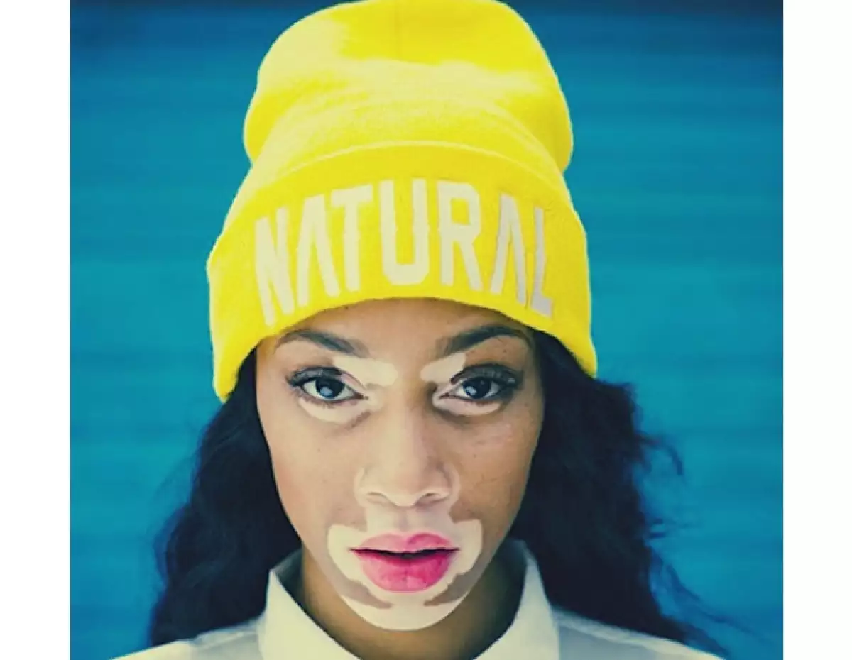 Modelo Winnie Harlow logra fama por tener vitiligo