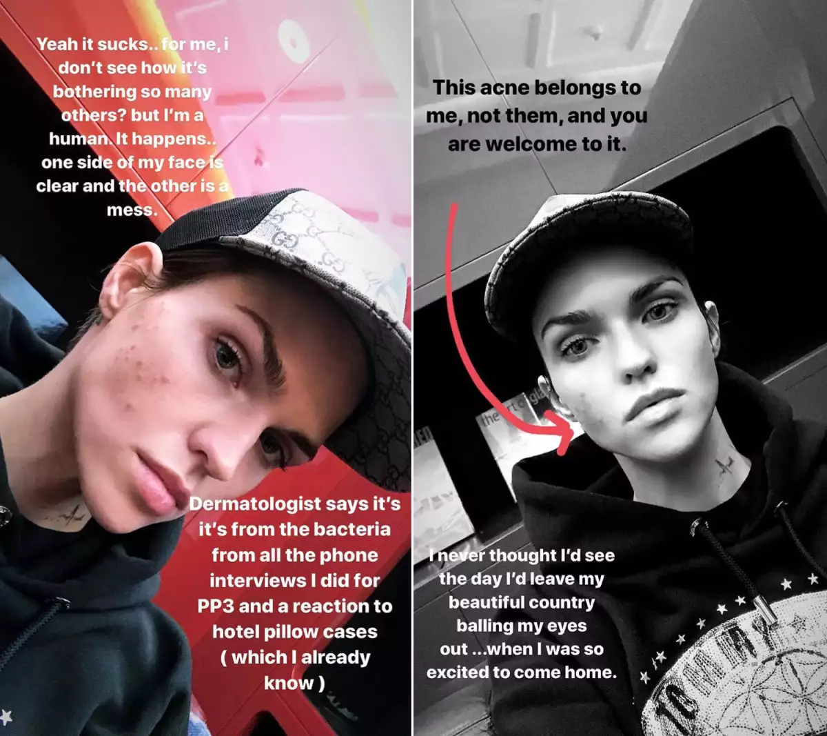 Ruby Rose muestra, muy orgullosa y segura de sí misma, su acné