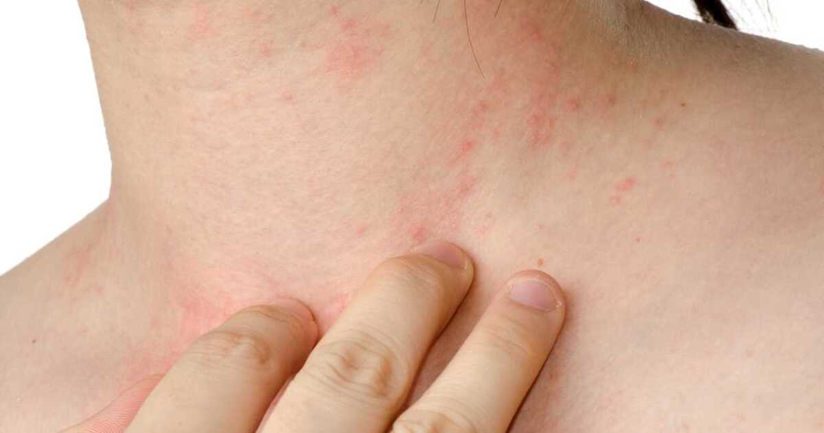La dermatitis atópica: una enfermedad tan popular como desconocida