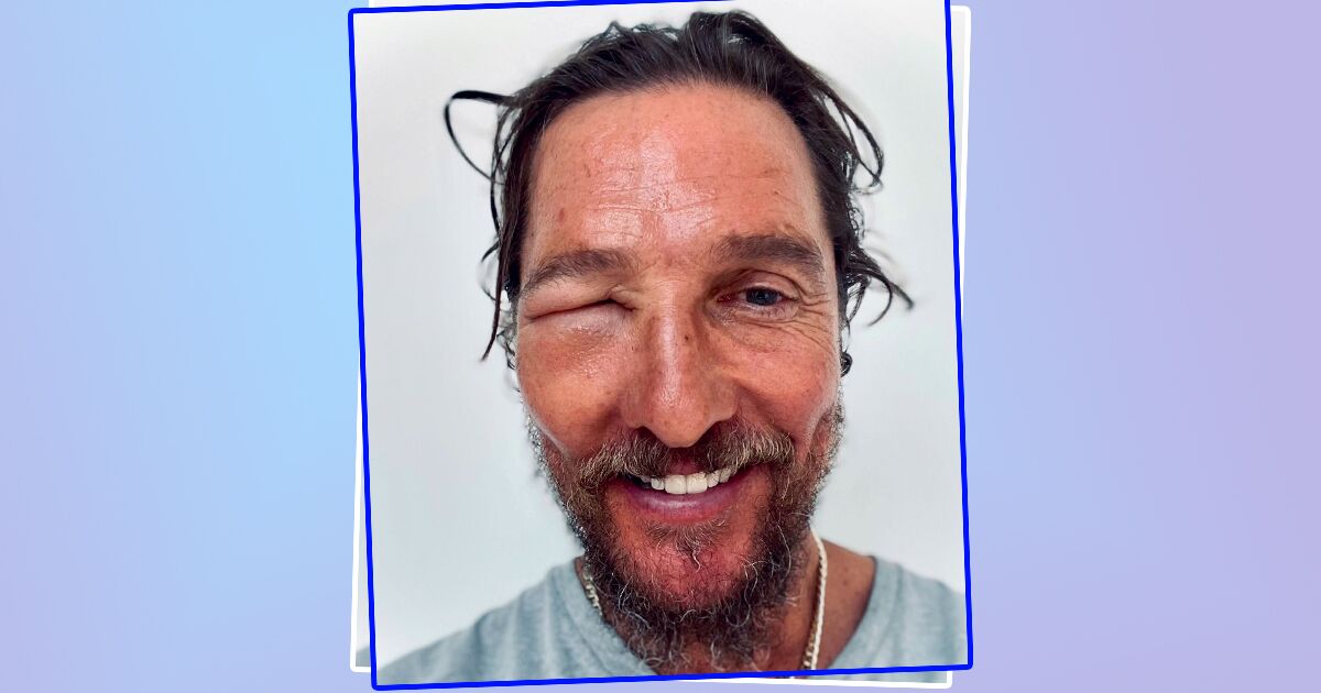 Matthew McConaughey muestra su ojo hinchado tras ser picado por una abeja
